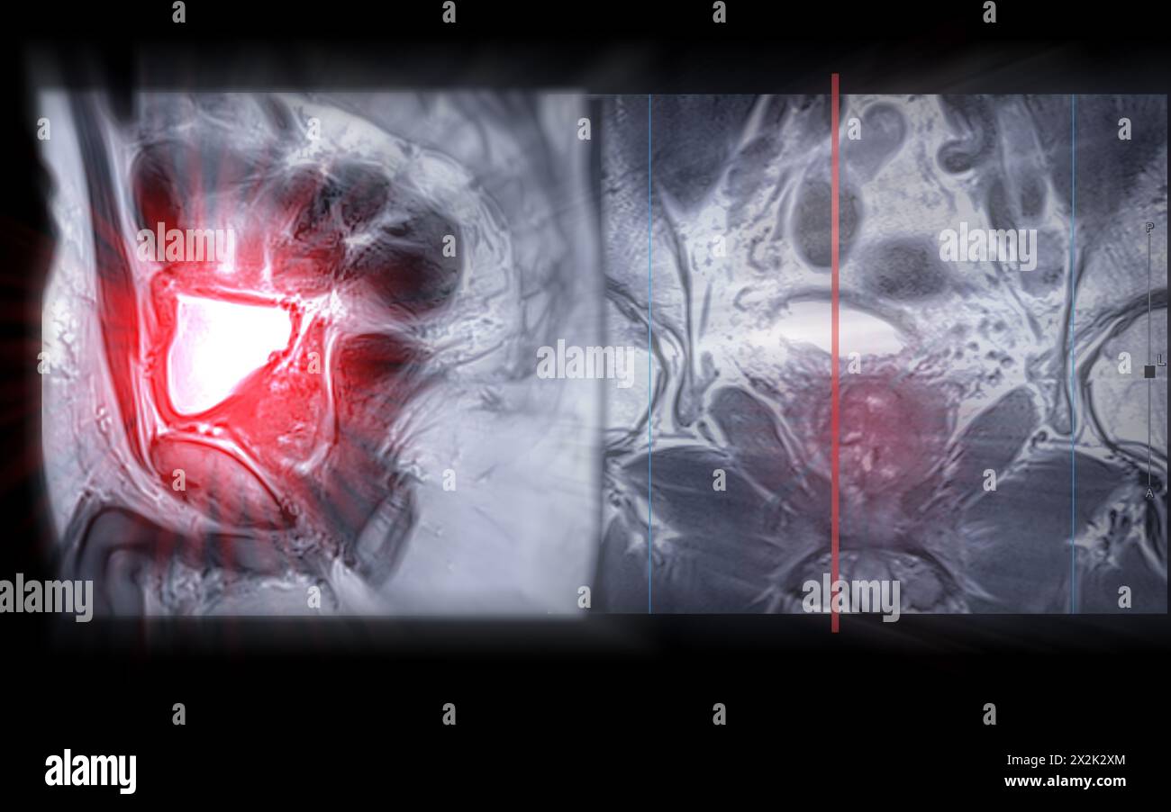 MRI of the prostate gland reveals Focal abnormal SI lesion at left PZpl ...