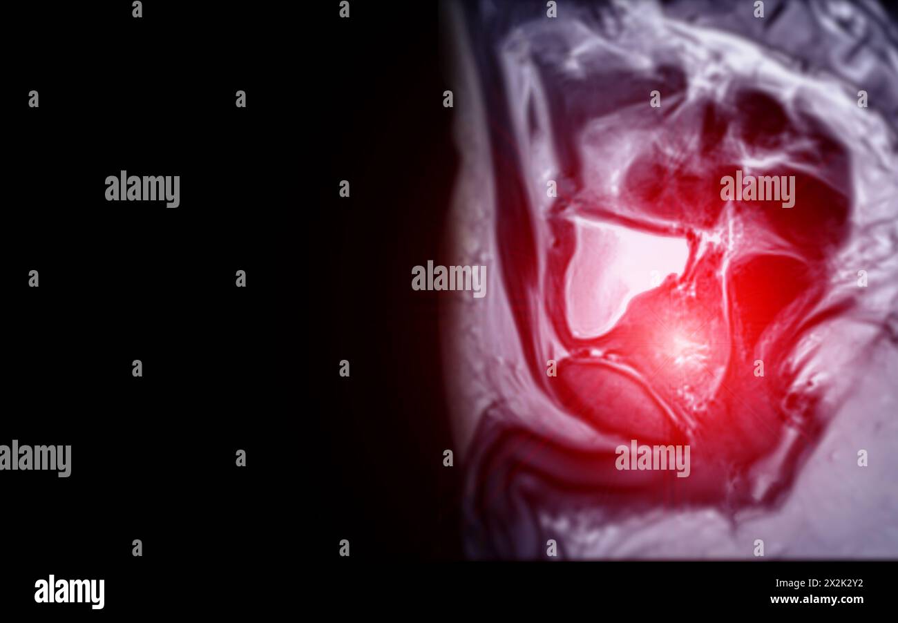 MRI of the prostate gland reveals Focal abnormal SI lesion at left PZpl ...