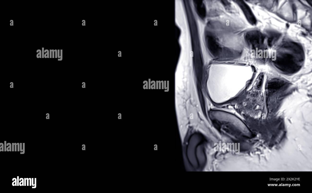 MRI of the prostate gland reveals Focal abnormal SI lesion at left PZpl ...