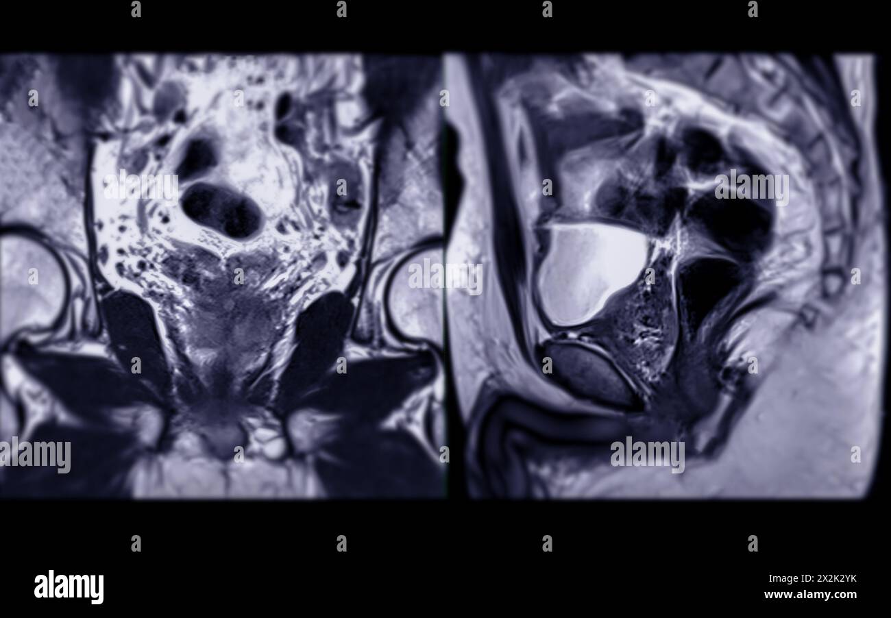 MRI of the prostate gland reveals Focal abnormal SI lesion at left PZpl ...