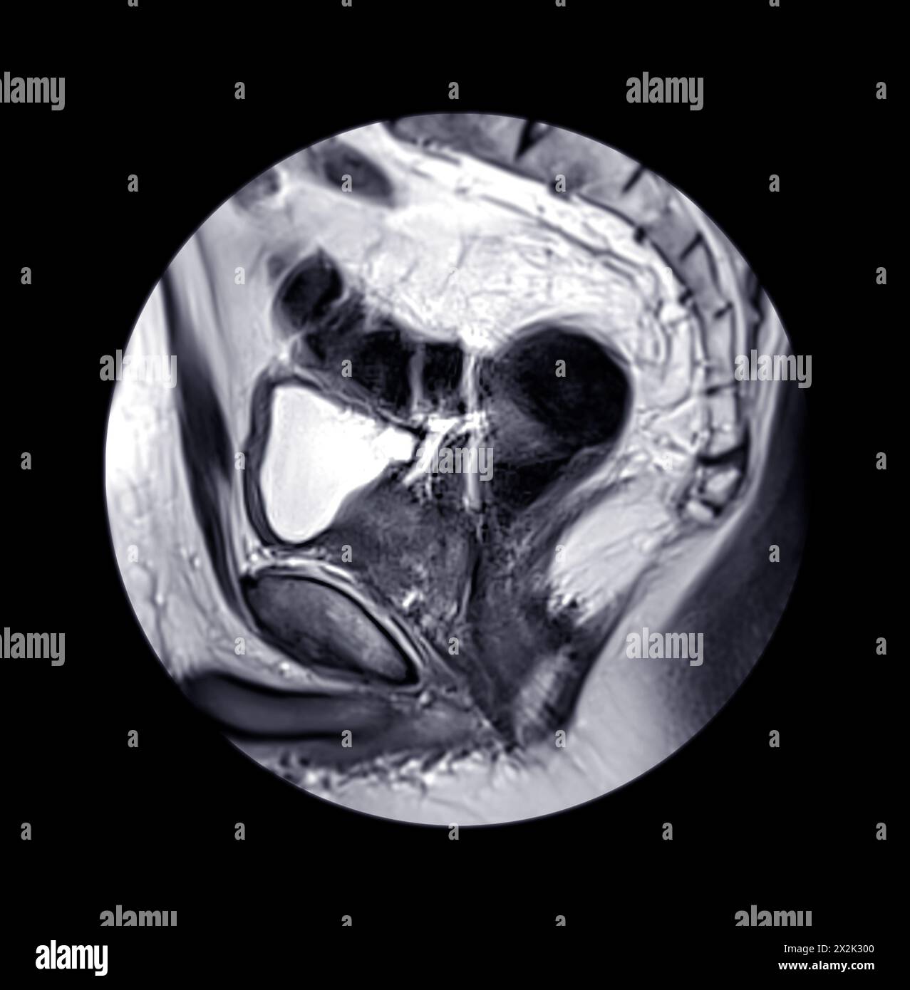 MRI of the prostate gland reveals Focal abnormal SI lesion at left PZpl ...