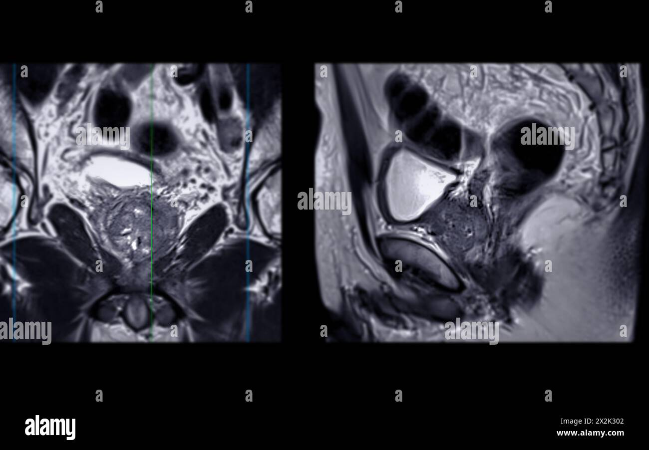 MRI of the prostate gland reveals Focal abnormal SI lesion at left PZpl ...