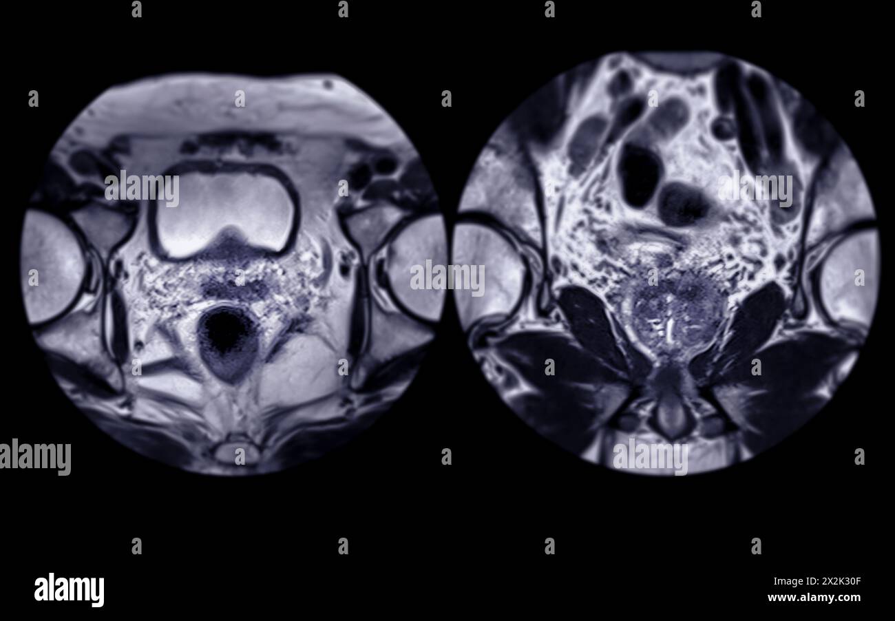 MRI of the prostate gland reveals Focal abnormal SI lesion at left PZpl ...