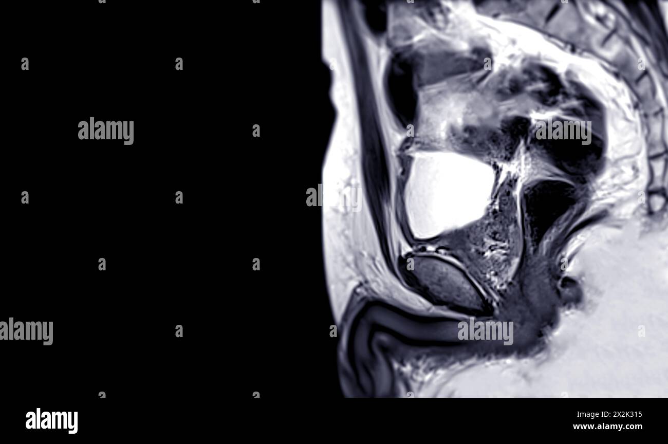MRI of the prostate gland reveals Focal abnormal SI lesion at left PZpl ...
