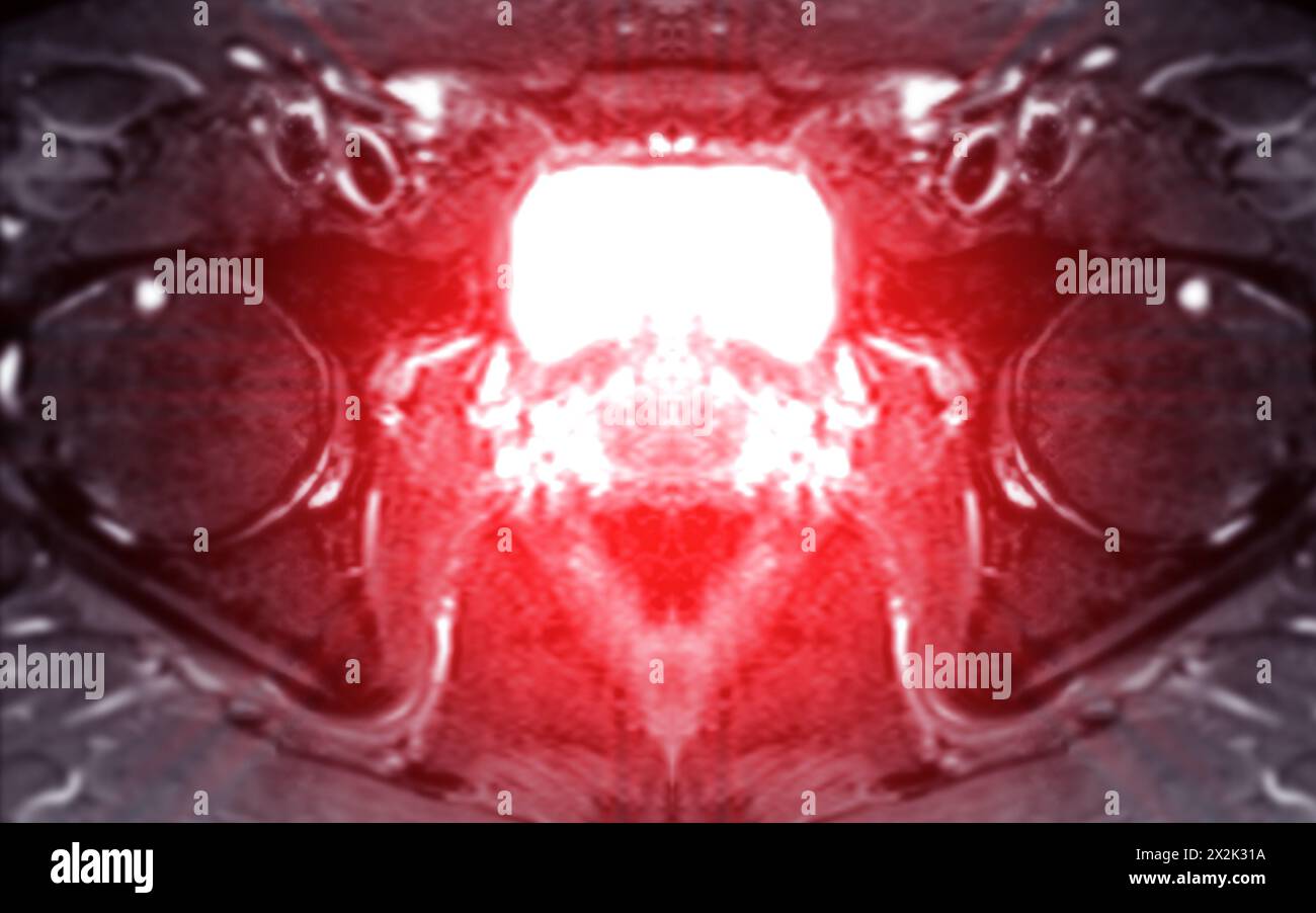 MRI of the prostate gland reveals Focal abnormal SI lesion at left PZpl ...