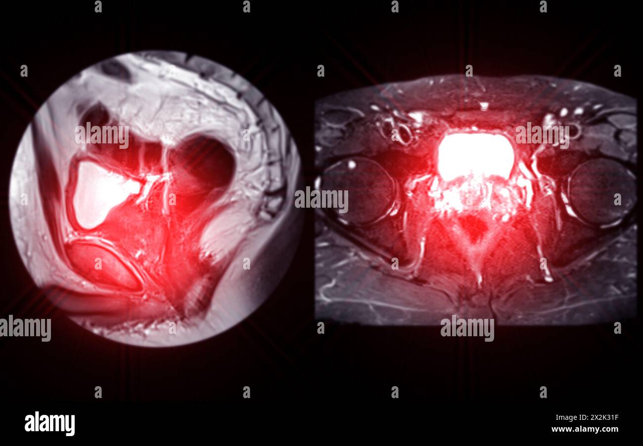 MRI of the prostate gland reveals Focal abnormal SI lesion at left PZpl ...