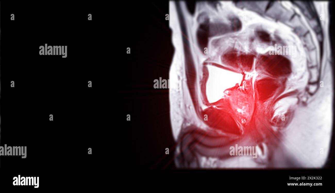 MRI of the prostate gland reveals Focal abnormal SI lesion at left PZpl ...