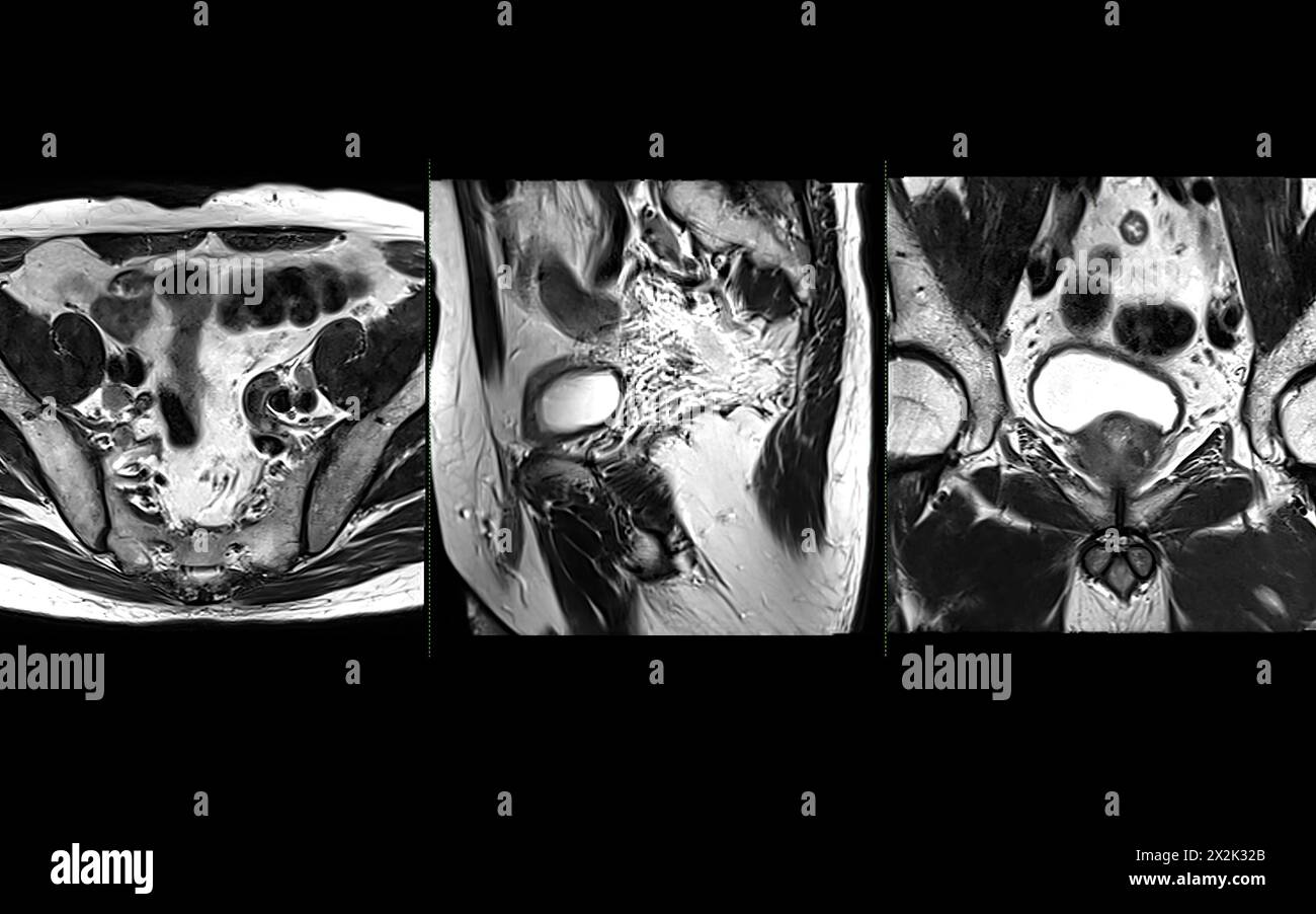 MRI of the prostate gland reveals Focal abnormal SI lesion at left PZpl ...