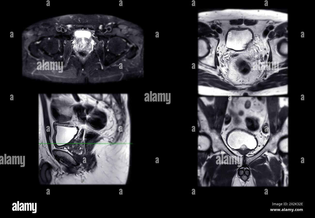 MRI of the prostate gland reveals Focal abnormal SI lesion at left PZpl ...