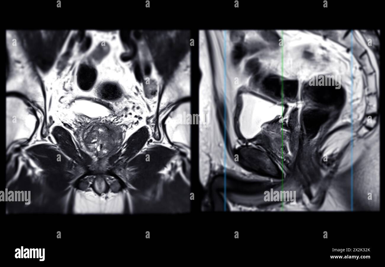 MRI of the prostate gland reveals Focal abnormal SI lesion at left PZpl ...