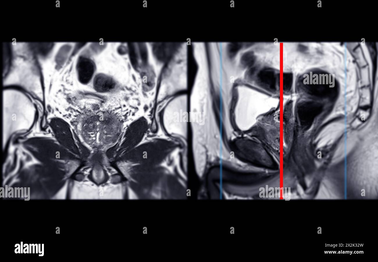 MRI of the prostate gland reveals Focal abnormal SI lesion at left PZpl ...