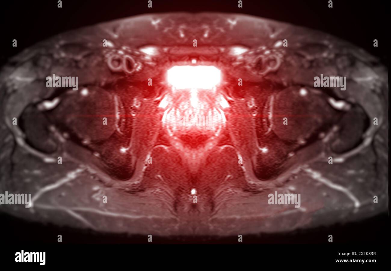 MRI of the prostate gland reveals Focal abnormal SI lesion at left PZpl ...