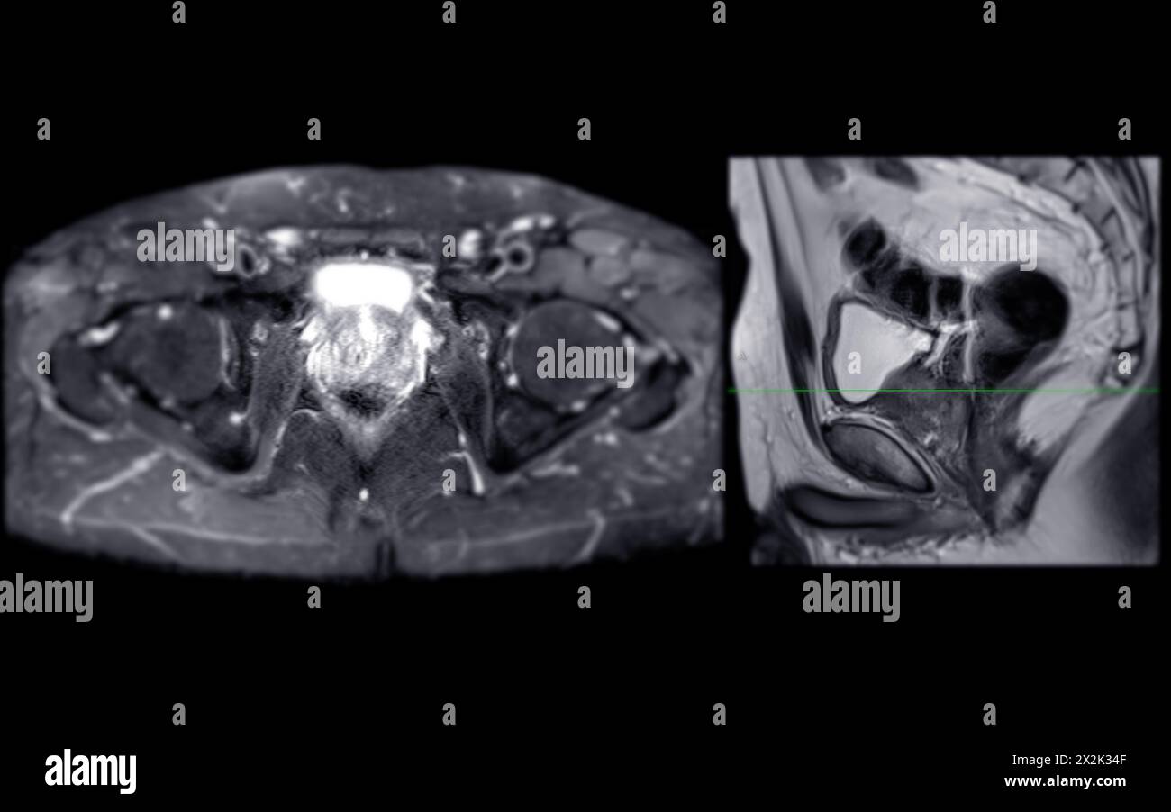 MRI of the prostate gland reveals Focal abnormal SI lesion at left PZpl ...
