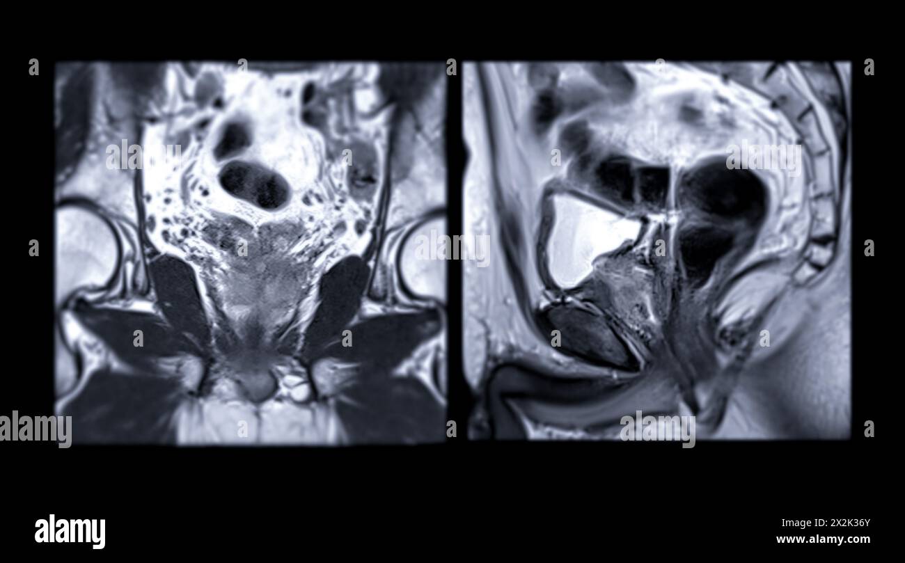 MRI of the prostate gland reveals Focal abnormal SI lesion at left PZpl ...