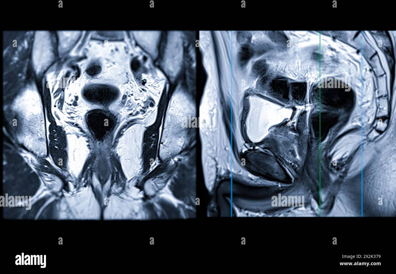 MRI of the prostate gland reveals Focal abnormal SI lesion at left PZpl ...