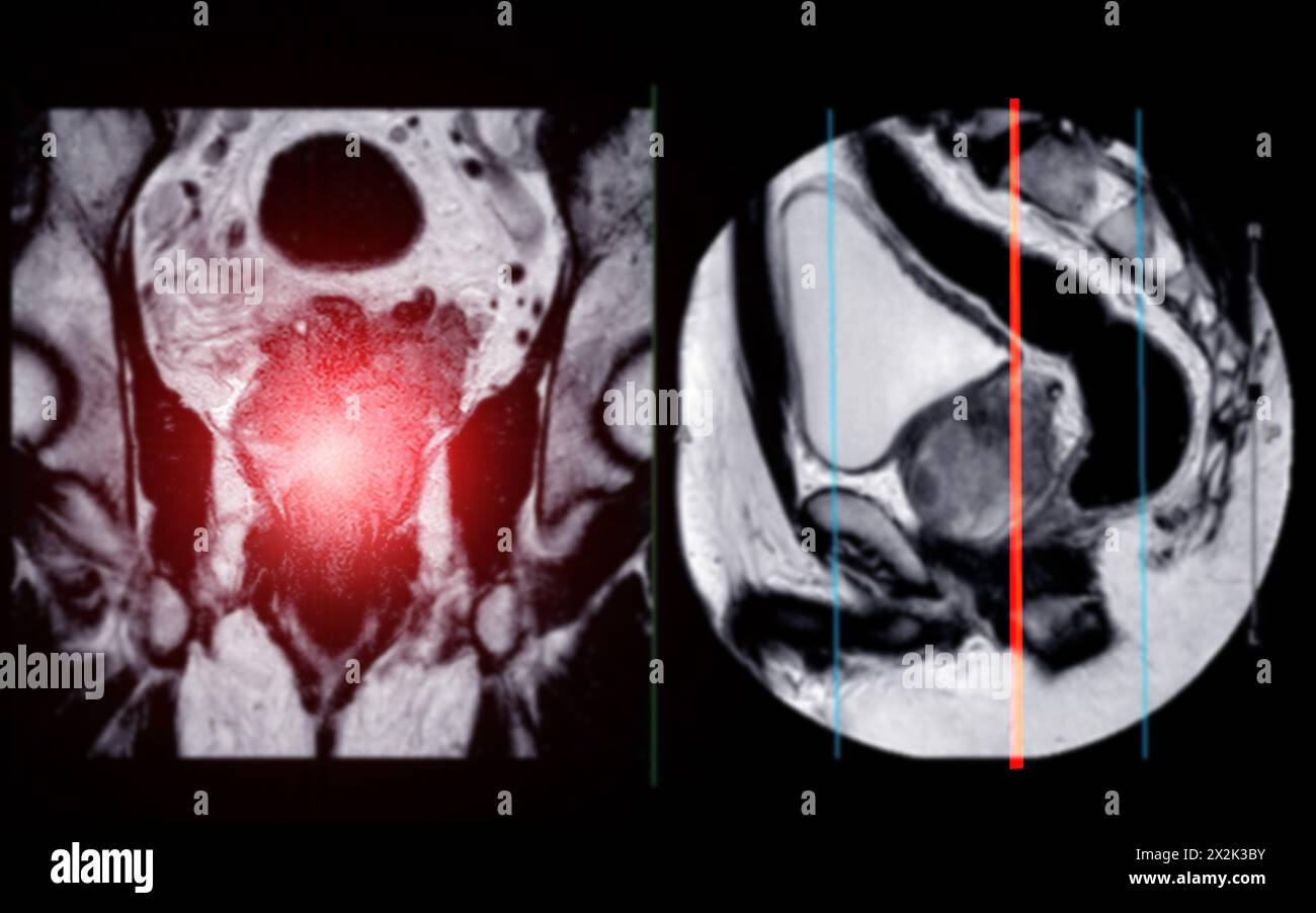 MRI of the prostate gland reveals a focal abnormal signal intensity (SI ...