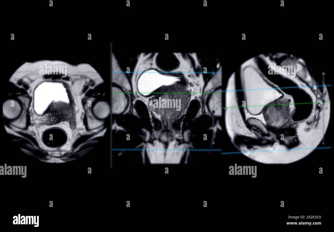 MRI of the prostate gland reveals a focal abnormal signal intensity (SI ...