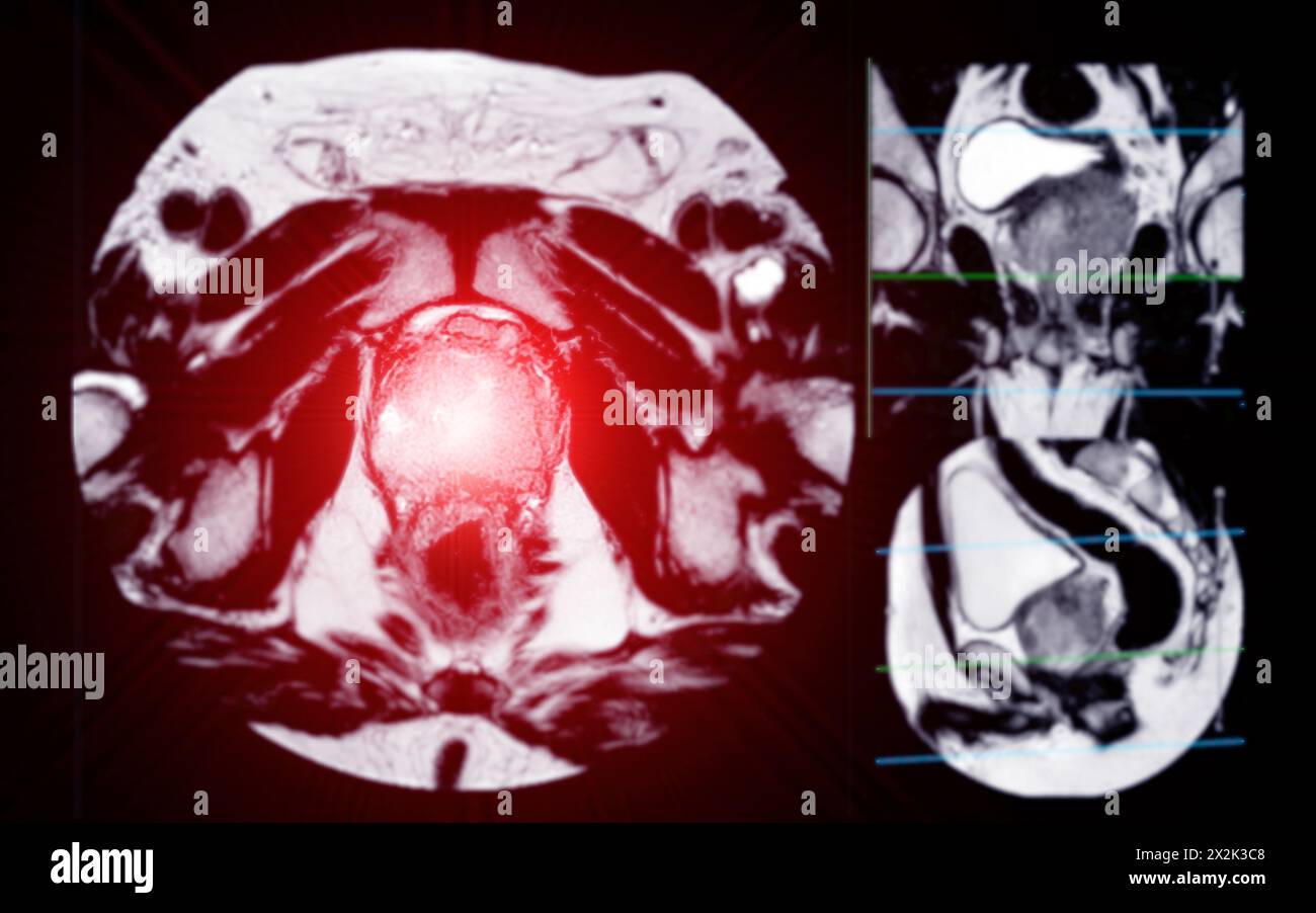 Mri Of The Prostate Gland Reveals A Focal Abnormal Signal Intensity Si