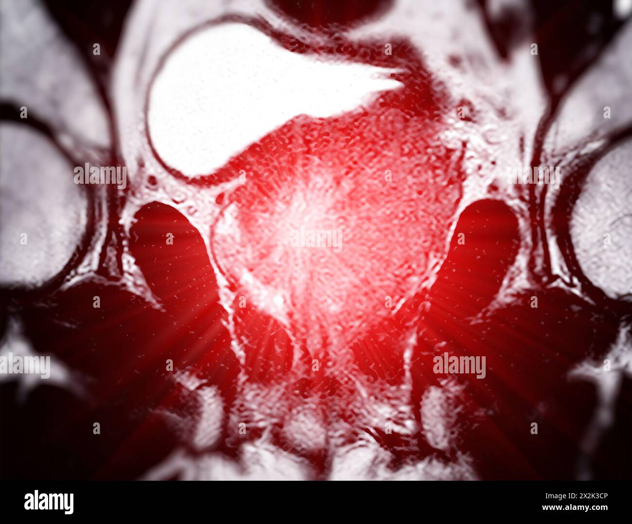 Mri Of The Prostate Gland Reveals A Focal Abnormal Signal Intensity Si