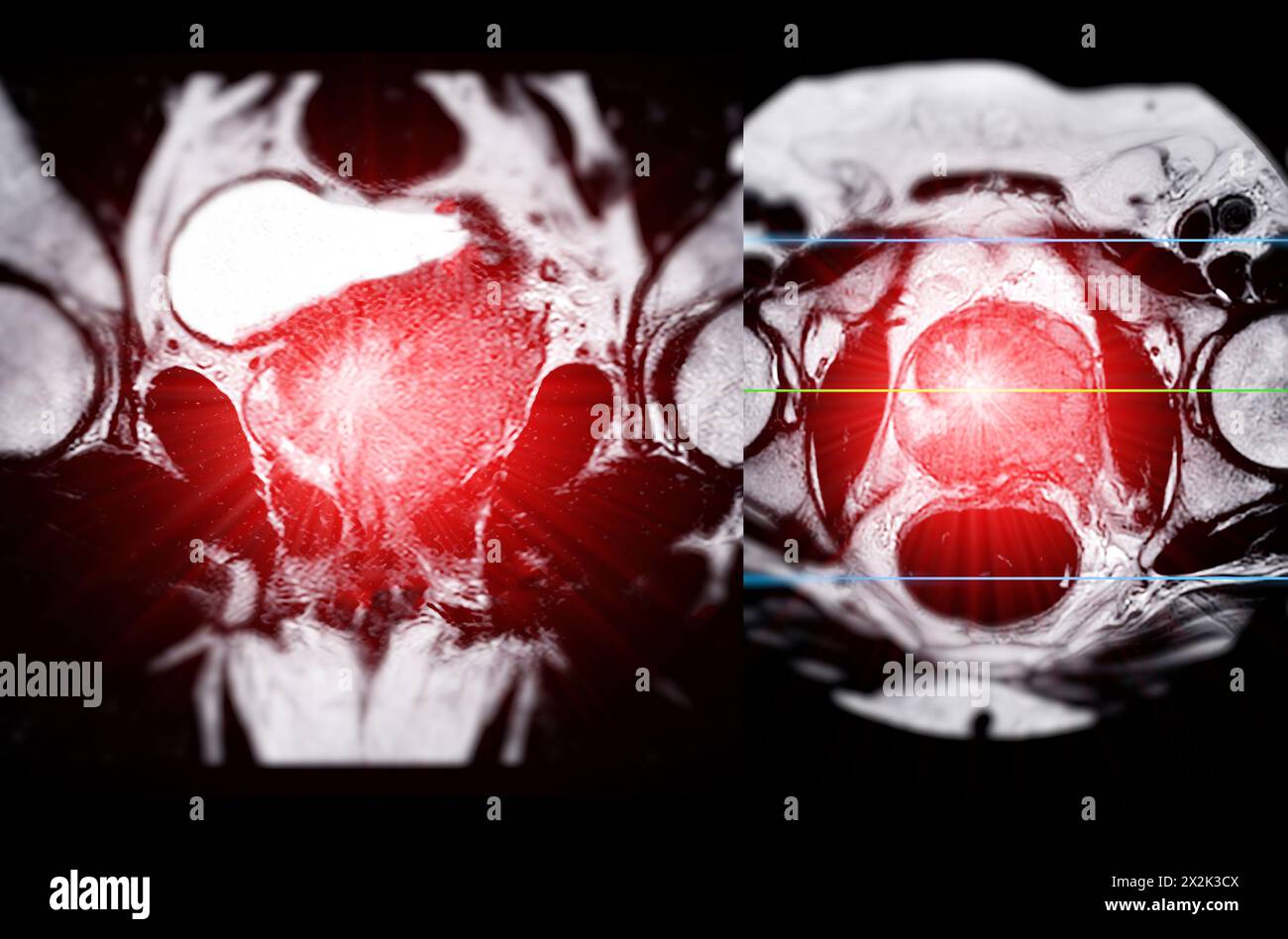 MRI of the prostate gland reveals a focal abnormal signal intensity (SI ...
