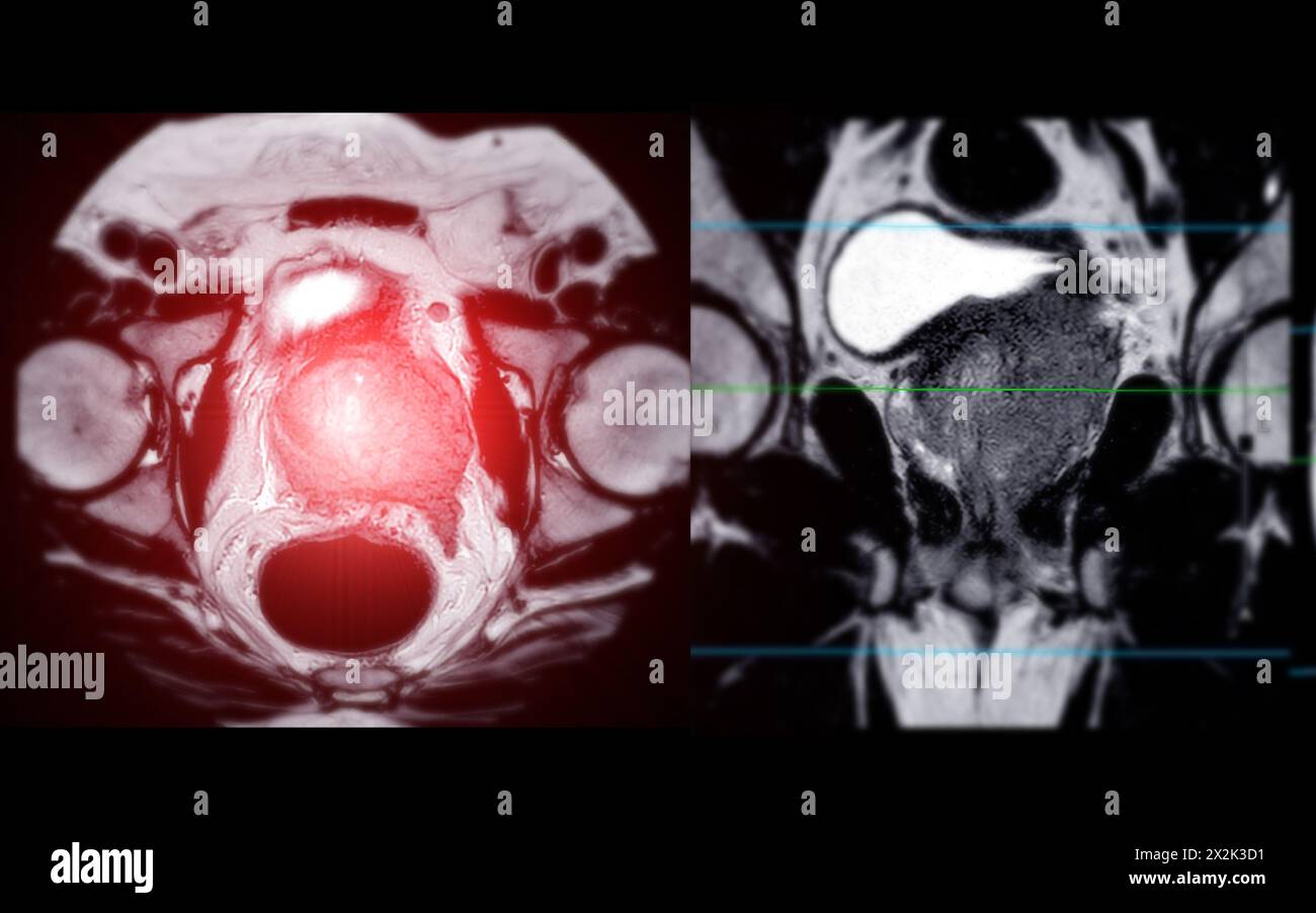 MRI of the prostate gland reveals a focal abnormal signal intensity (SI ...