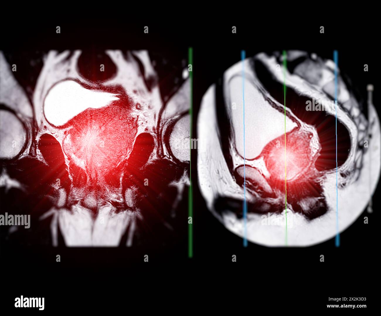 Mri Of The Prostate Gland Reveals A Focal Abnormal Signal Intensity Si