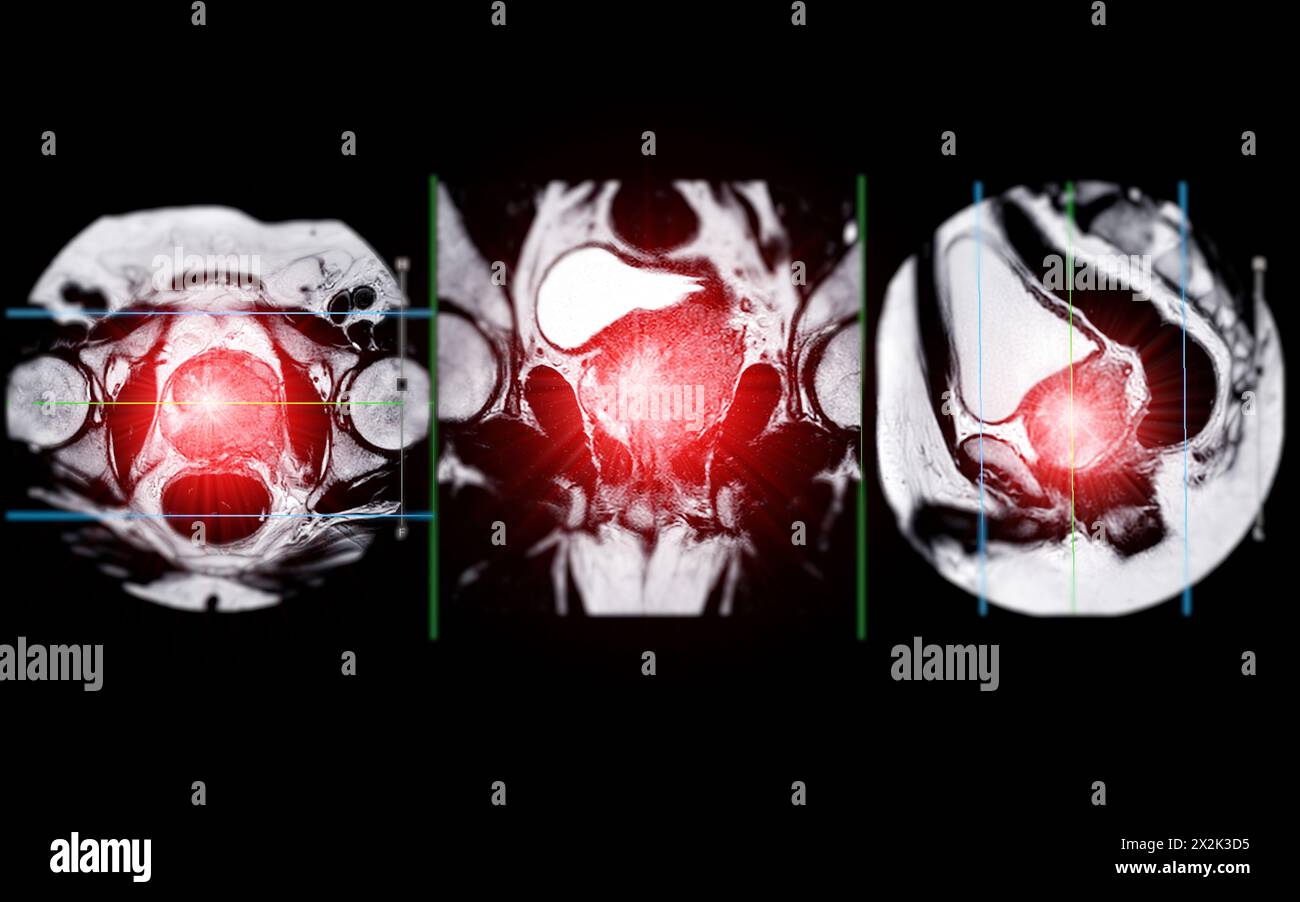 MRI of the prostate gland reveals a focal abnormal signal intensity (SI ...