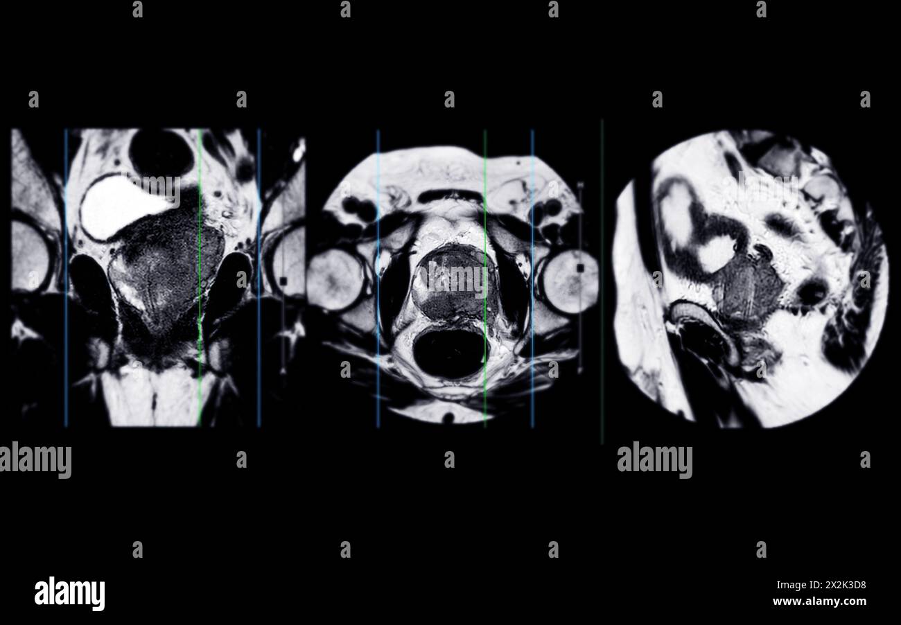 Mri Of The Prostate Gland Reveals A Focal Abnormal Signal Intensity Si Lesion At The Left