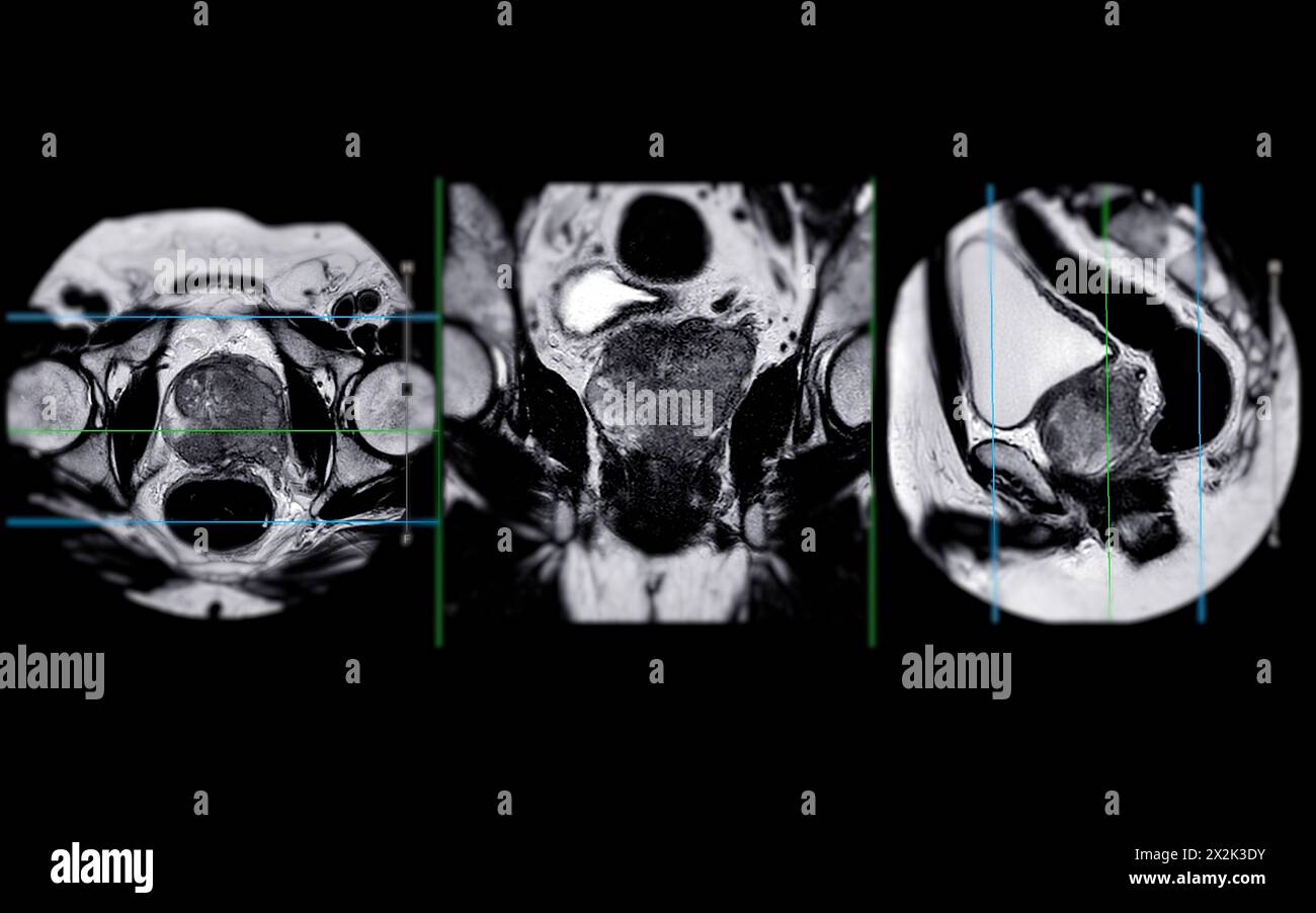 MRI of the prostate gland reveals a focal abnormal signal intensity (SI ...