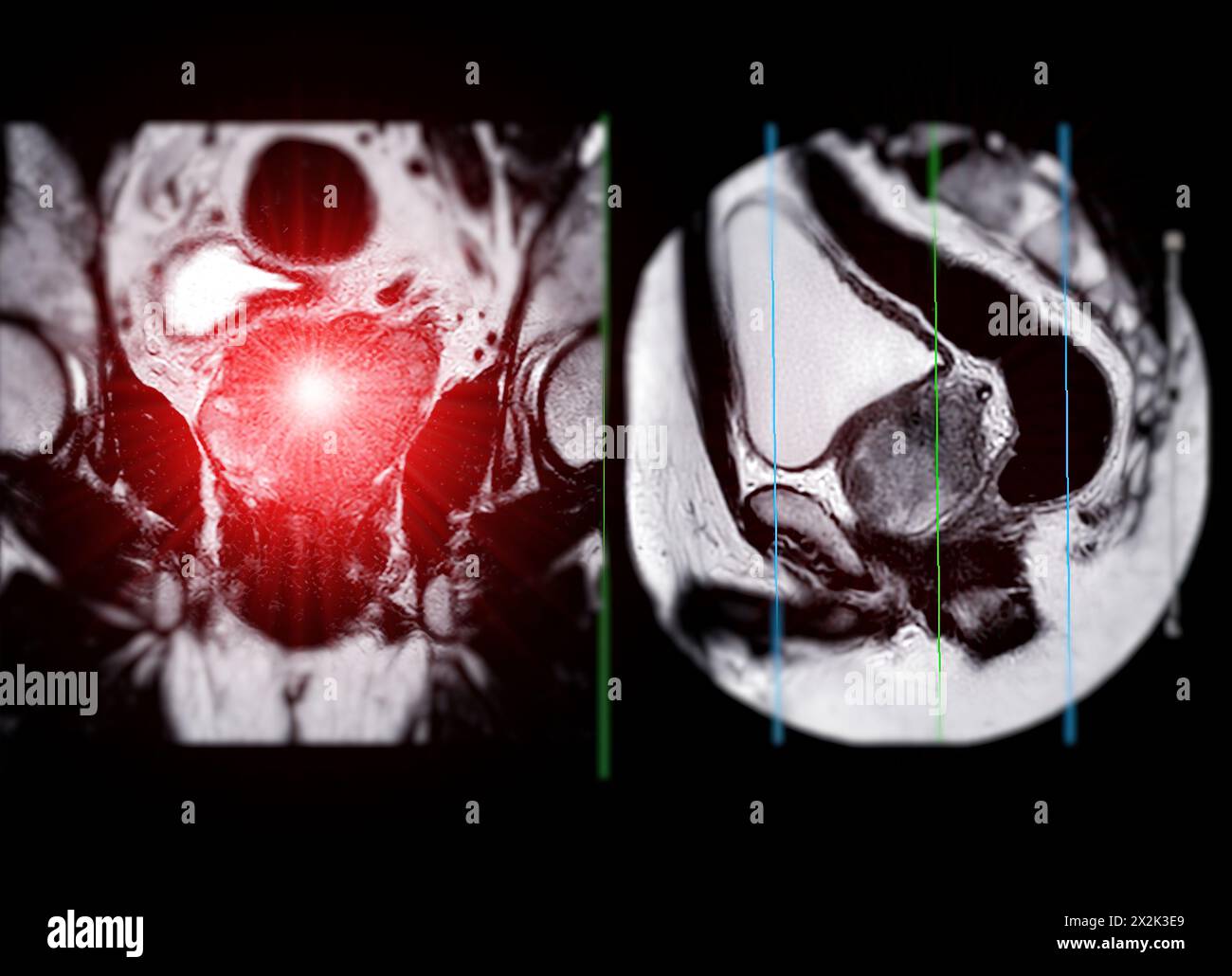 MRI of the prostate gland reveals a focal abnormal signal intensity (SI ...