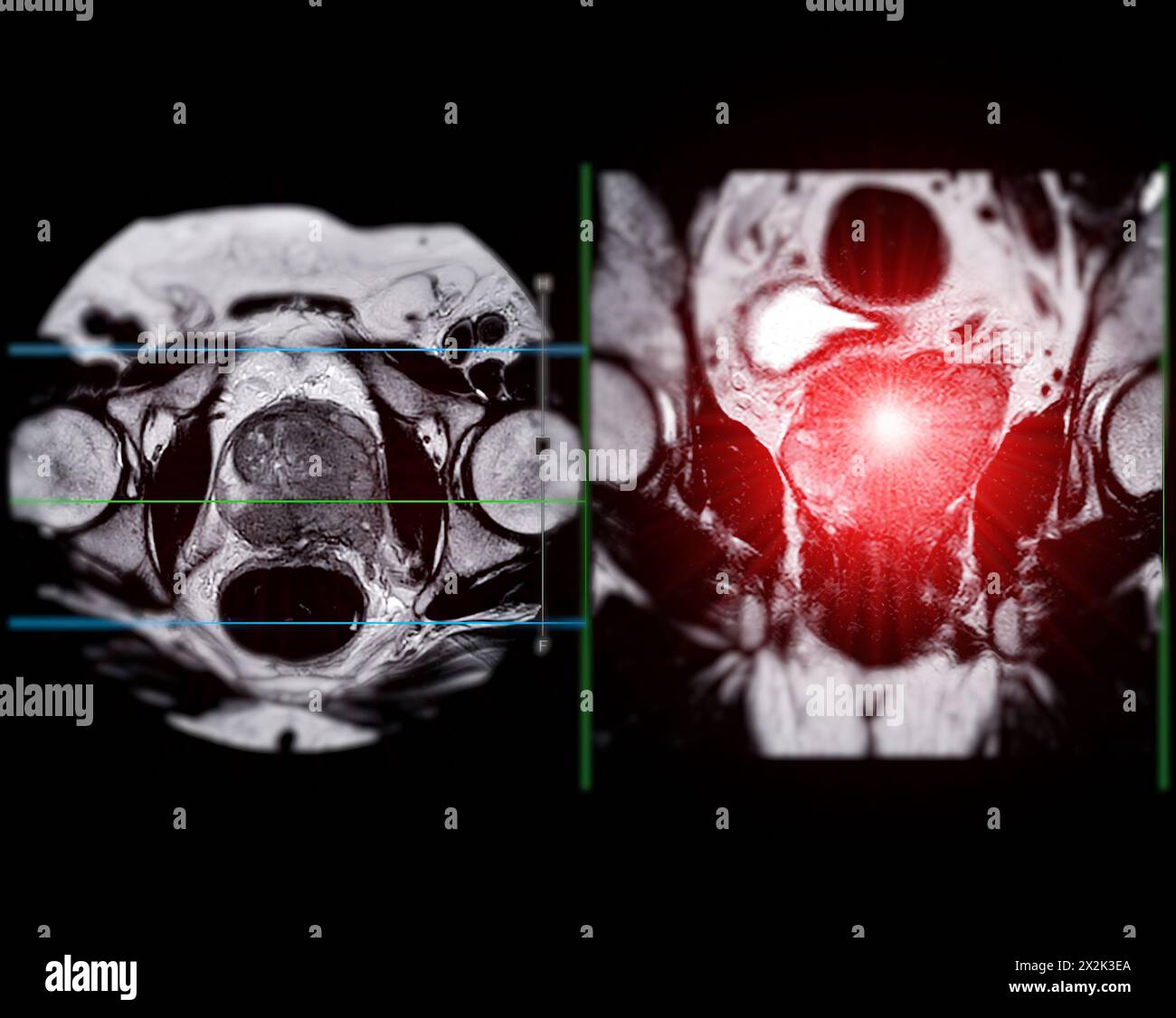 MRI of the prostate gland reveals a focal abnormal signal intensity (SI ...