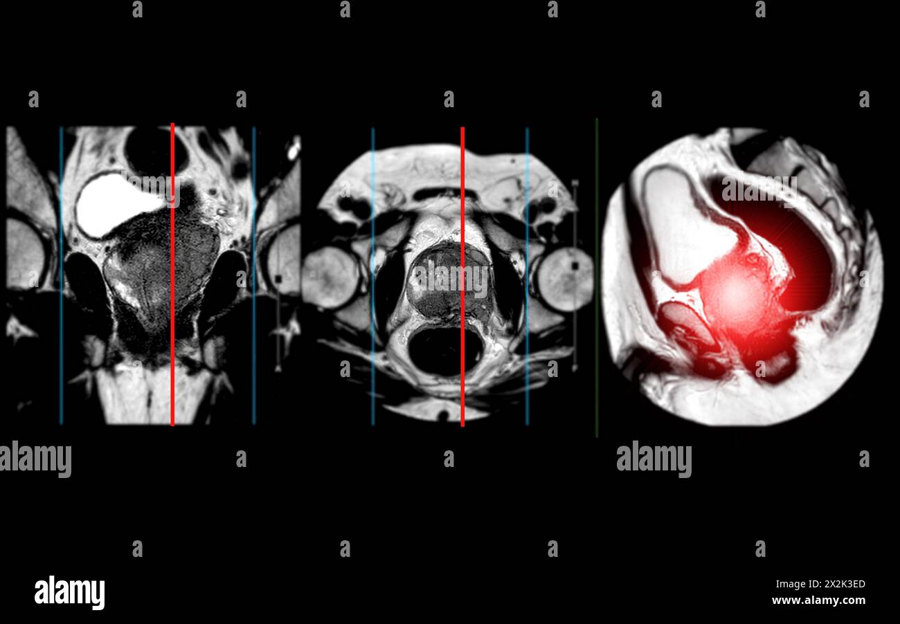 MRI of the prostate gland reveals a focal abnormal signal intensity (SI ...