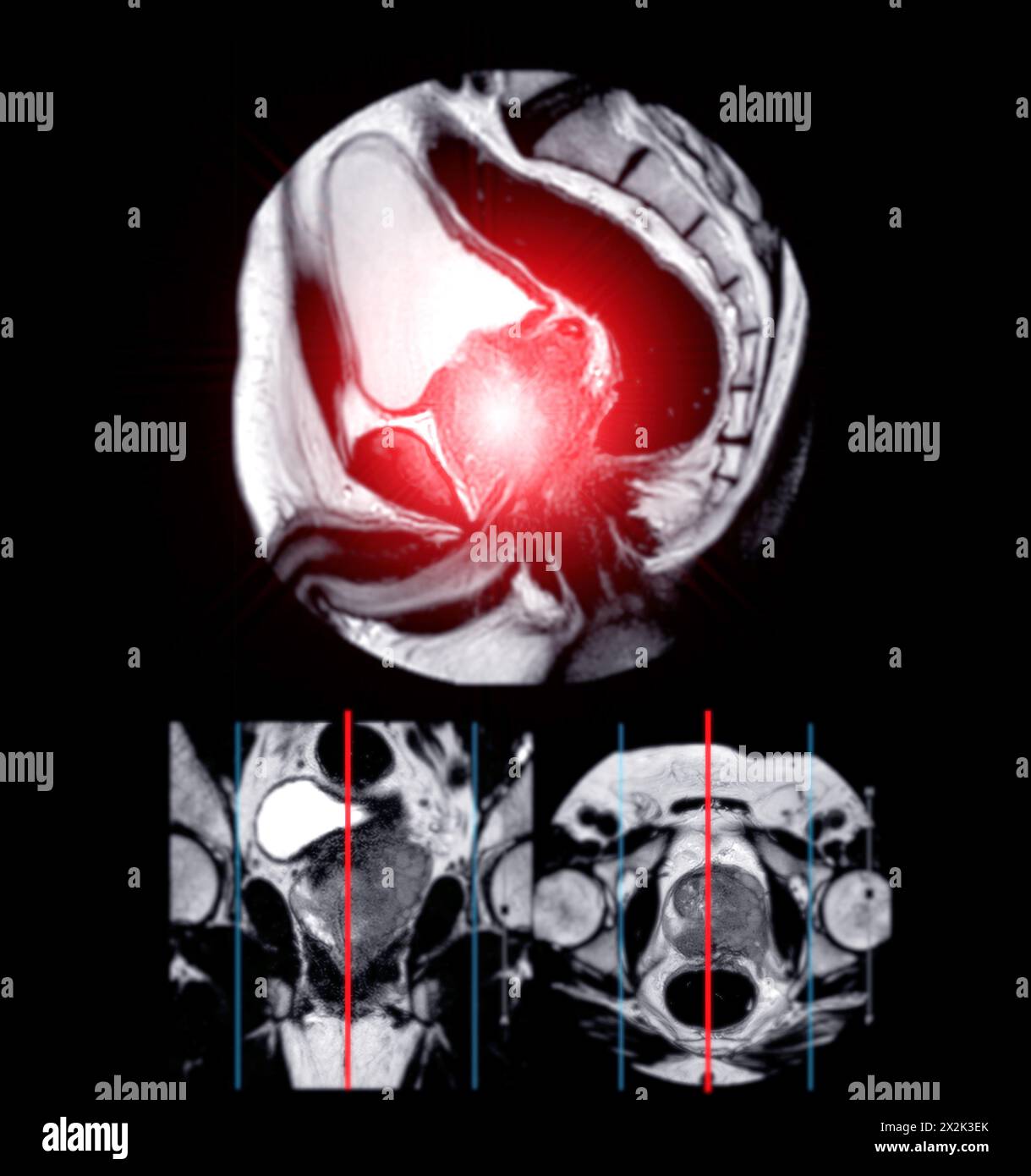 MRI of the prostate gland reveals a focal abnormal signal intensity (SI ...