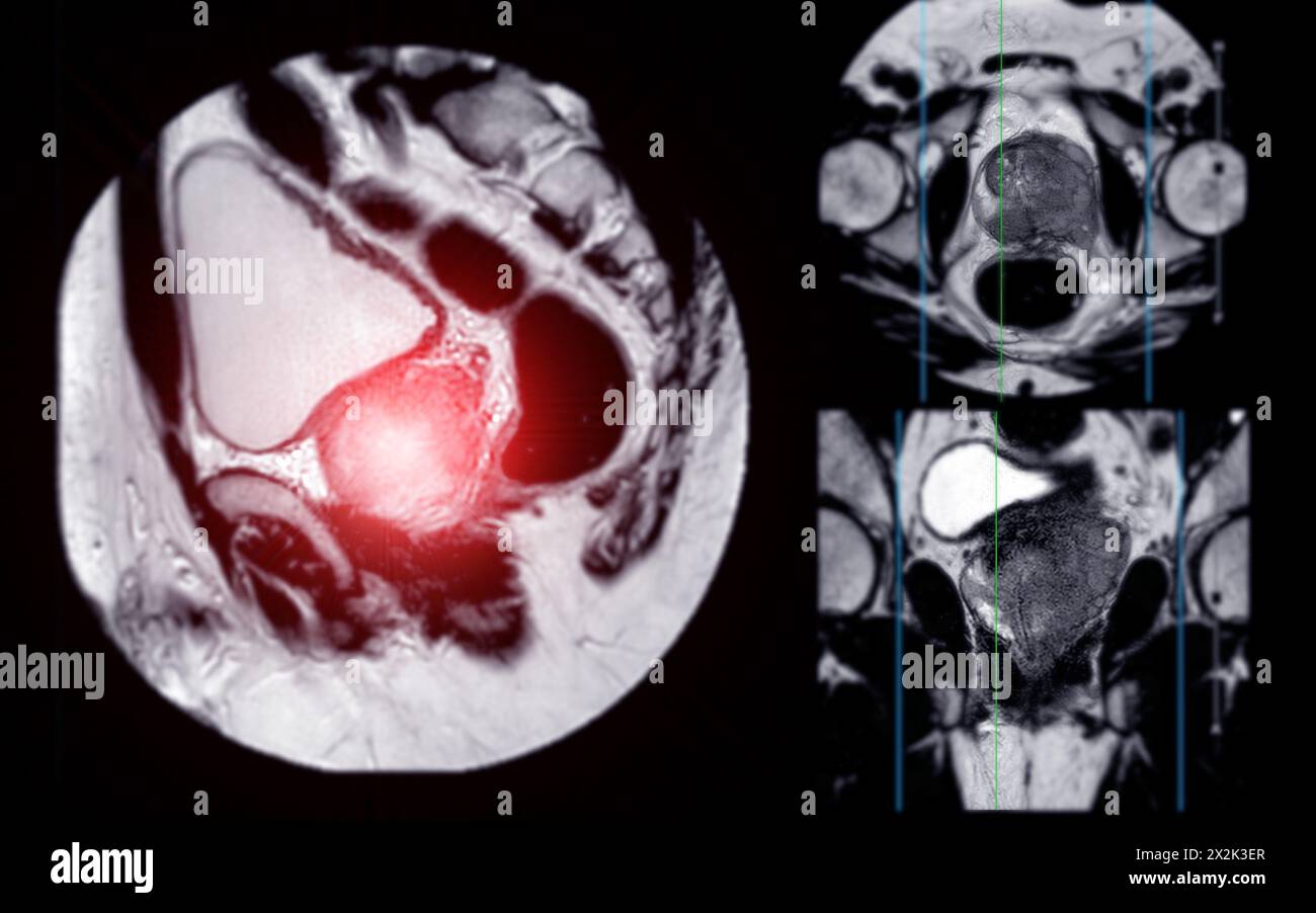 Enlarged prostate hi-res stock photography and images - Alamy