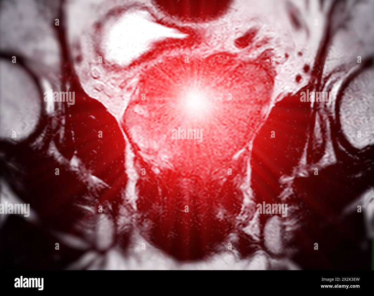 MRI of the prostate gland reveals a focal abnormal signal intensity (SI ...
