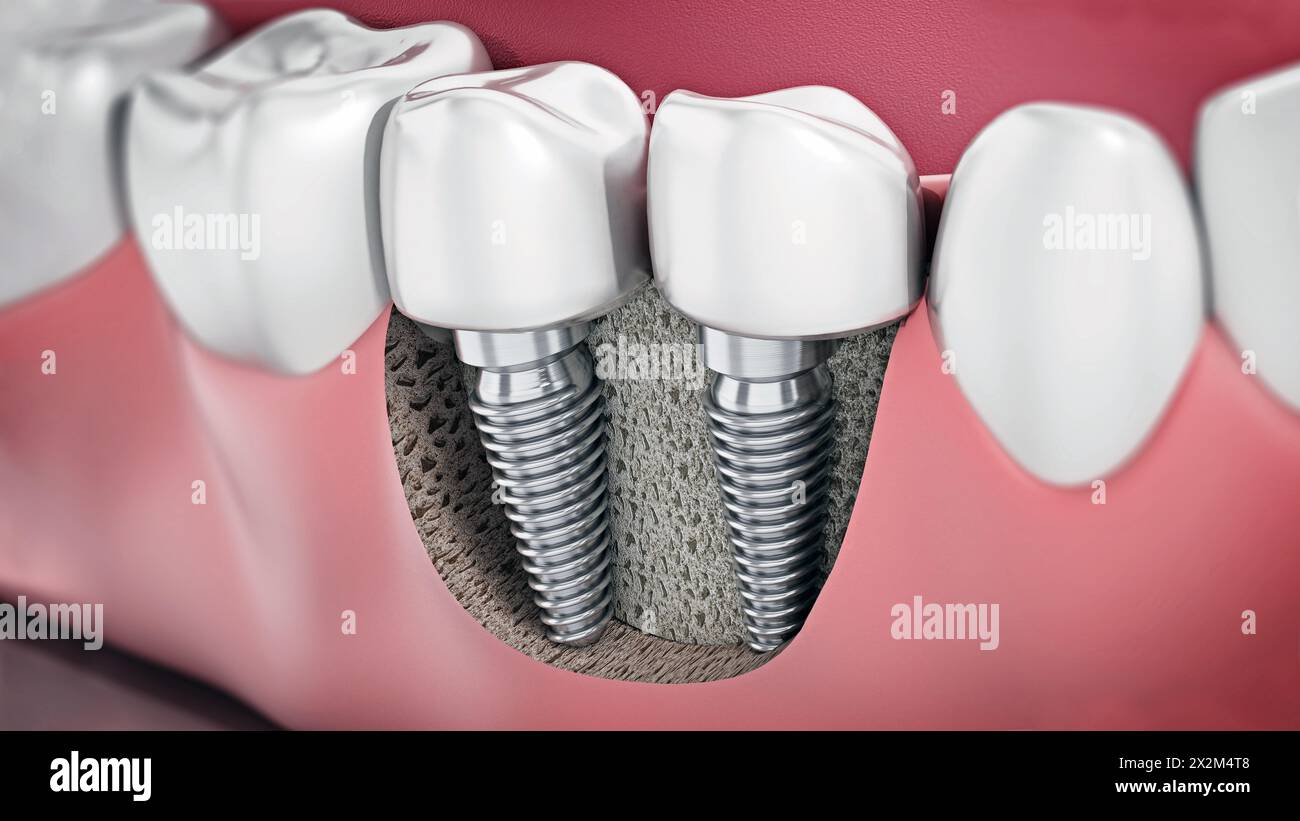 3D illustration of two dental implants on the lower jaw Stock Photo - Alamy