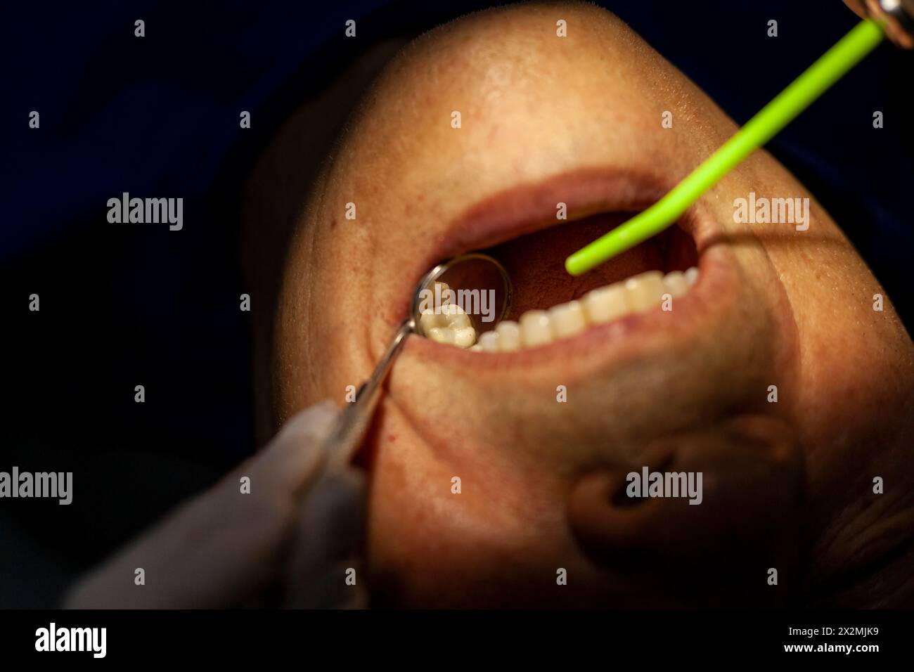 Dentis hi-res stock photography and images - Alamy
