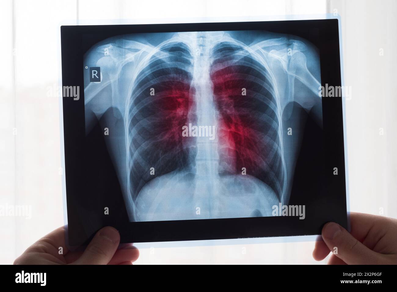 Lung radiography concept. Radiology doctor examining at chest x ray ...