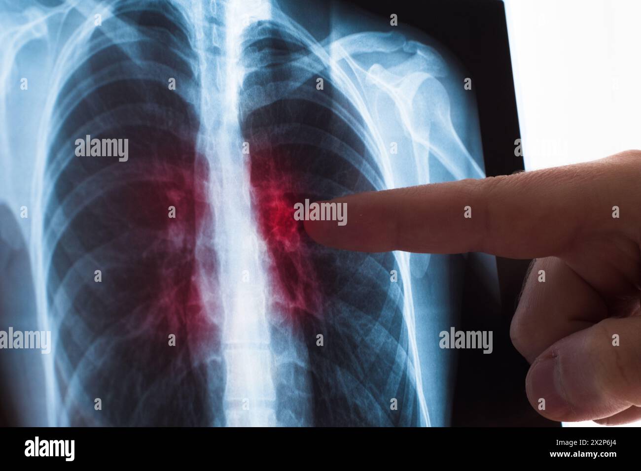 Lung radiography concept. Radiology doctor examining at chest x ray ...
