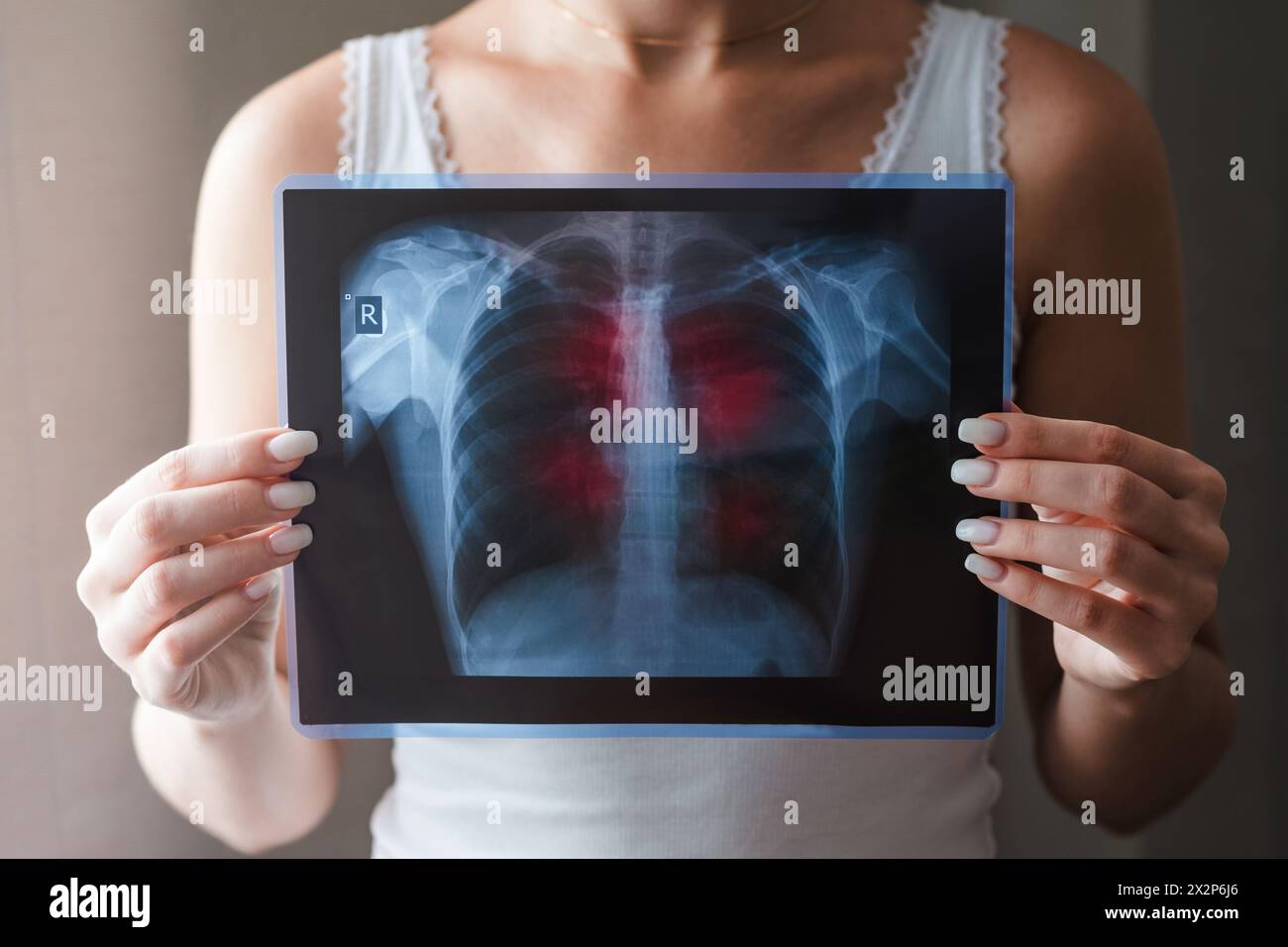 Lung radiography concept. Virus and bacteria infected the Human lungs ...