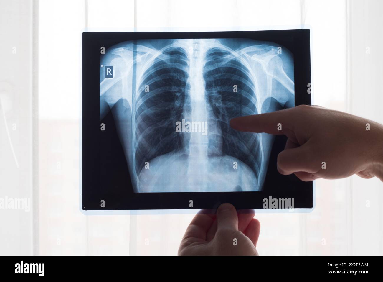 Lung radiography concept. Radiology doctor examining at chest x ray ...
