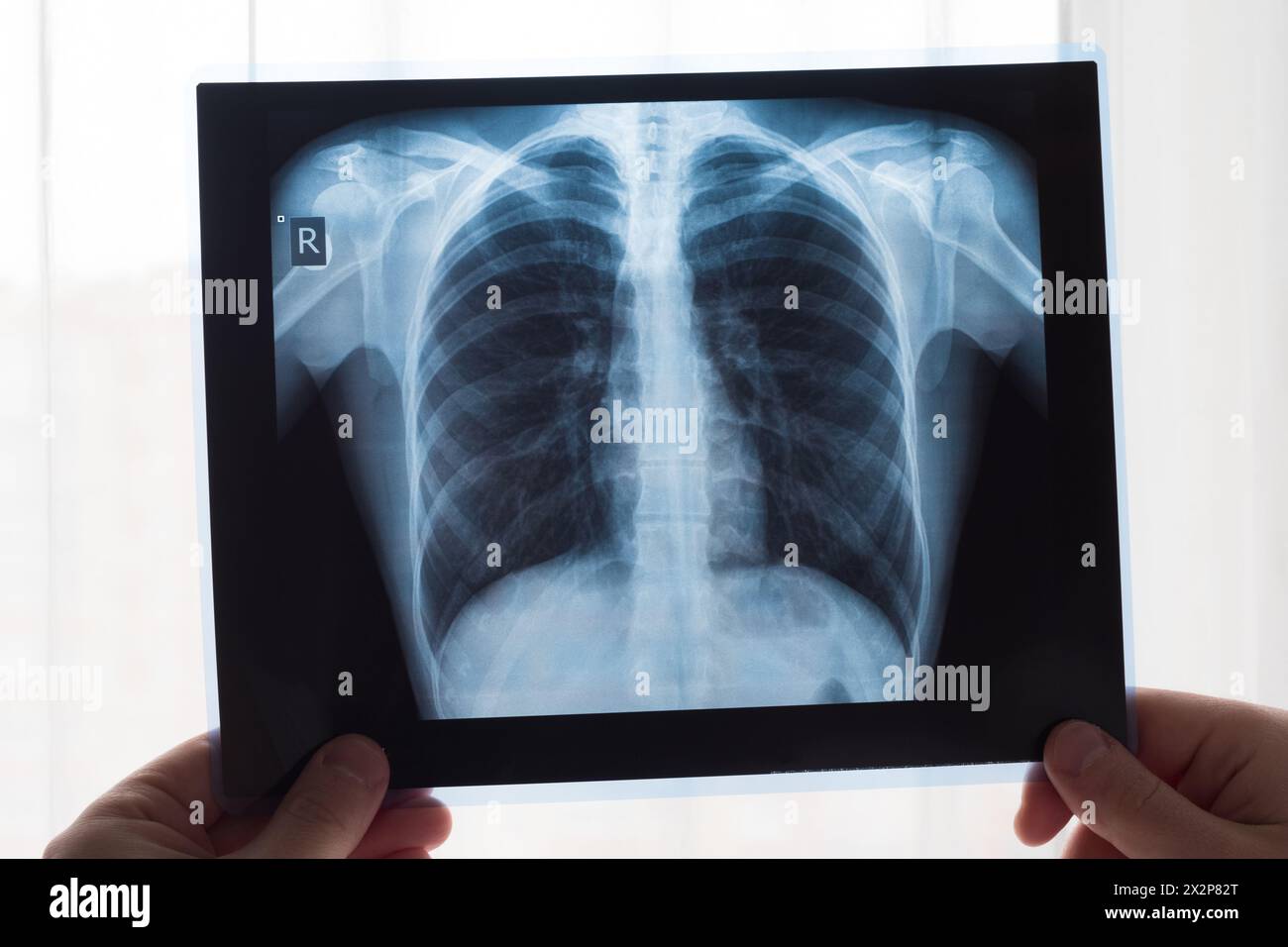 Lung radiography concept. Radiology doctor examining at chest x ray ...