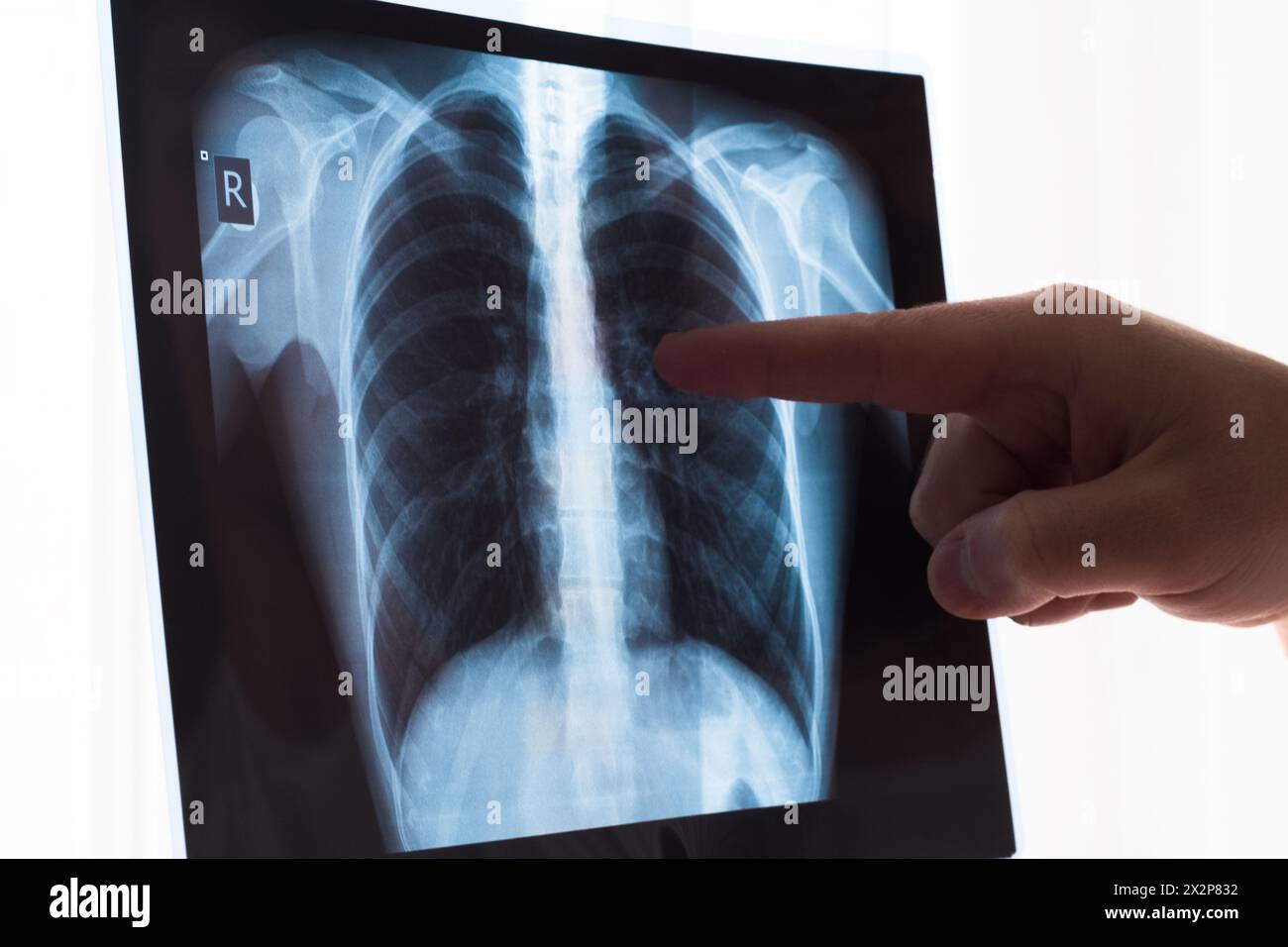 Lung radiography concept. Radiology doctor examining at chest x ray ...