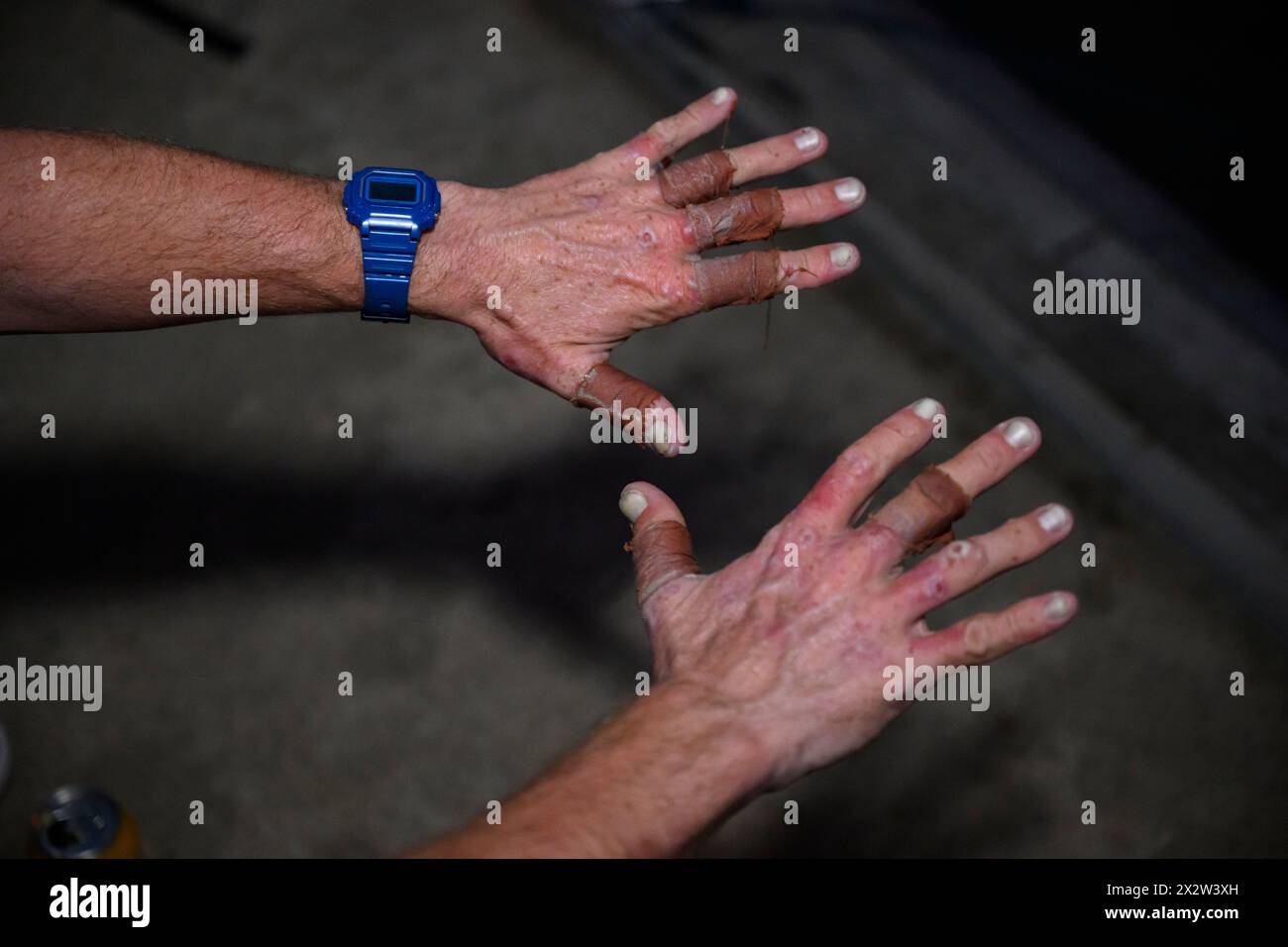 Port Douglas, Australia. 23rd Apr, 2024. Wounds and scars seen on ...