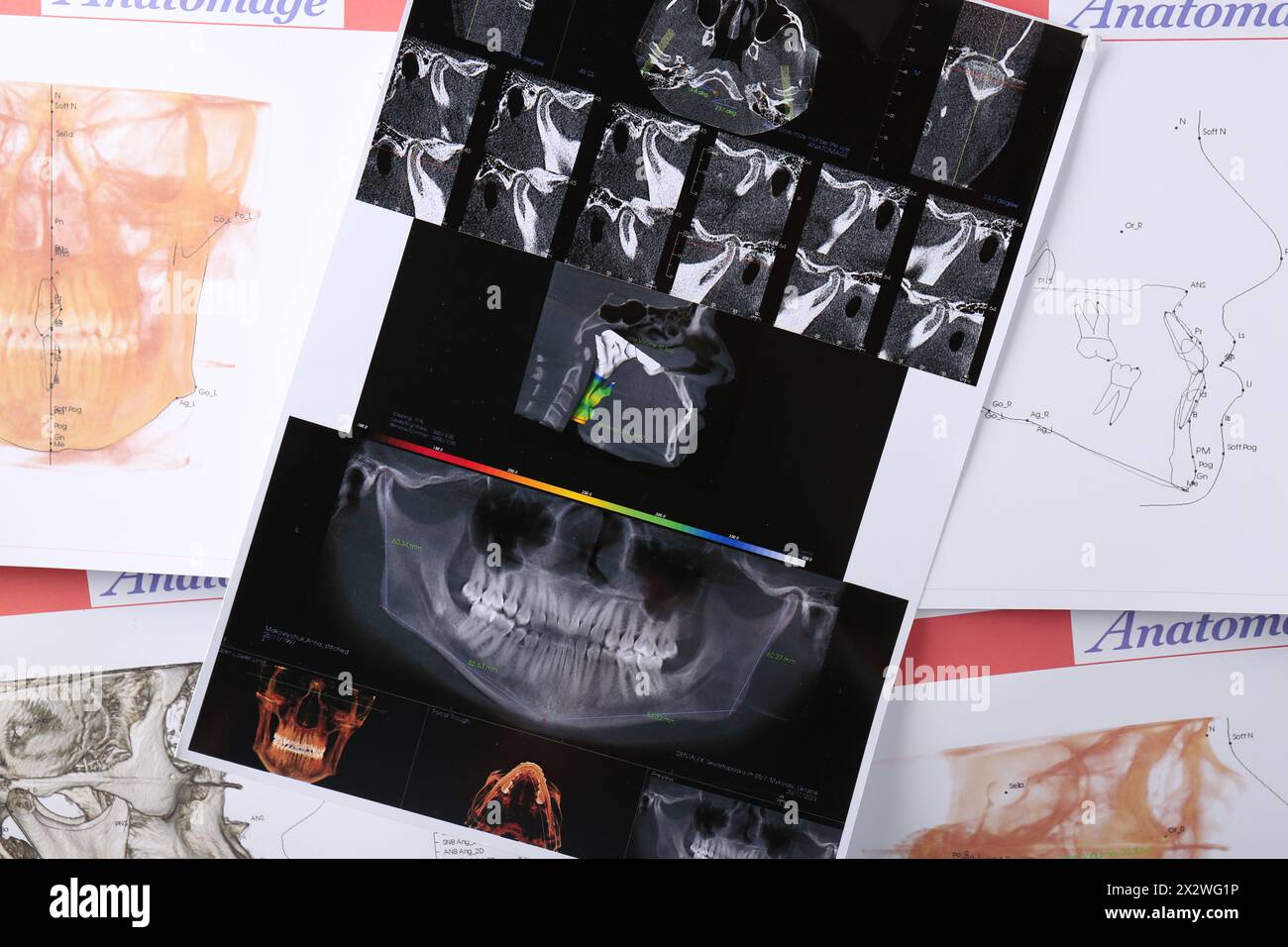 Panoramic x-ray and dental anatomy charts as background, top view Stock ...
