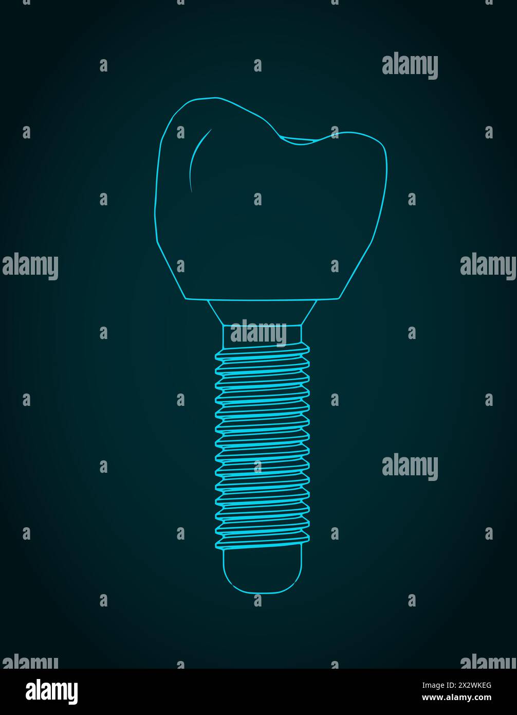 Stylized vector illustration of blueprint of dental prosthesis Stock ...