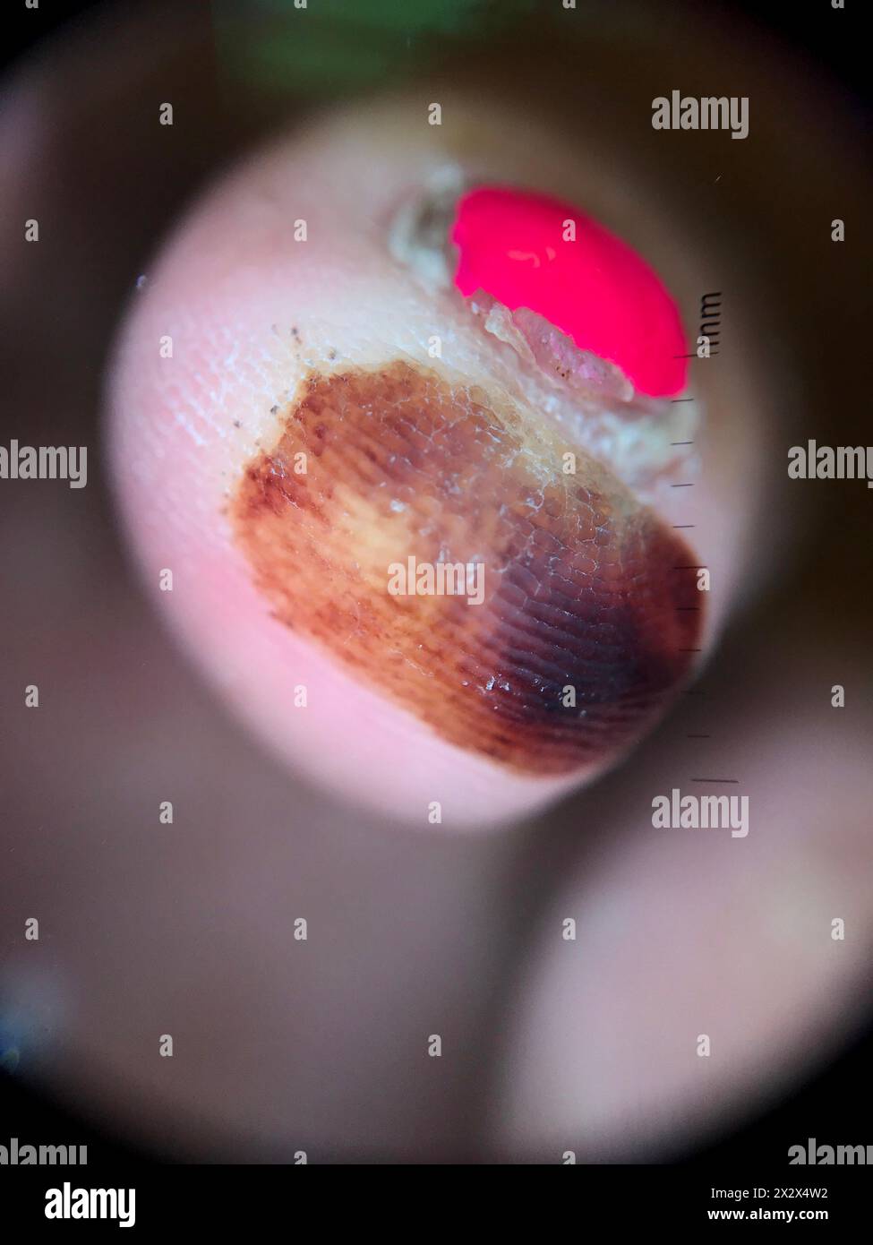 Dermatoscope image of a haematoma on a patient's toe due to trauma. A ...