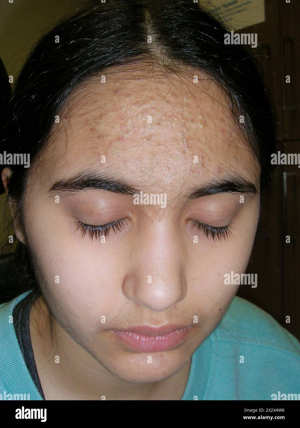 Acne on a patient's forehead. Acne is a general name given to a skin ...