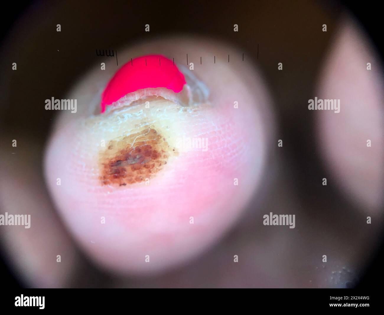 Dermatoscope image of a haematoma on a patient's toe due to trauma. A ...