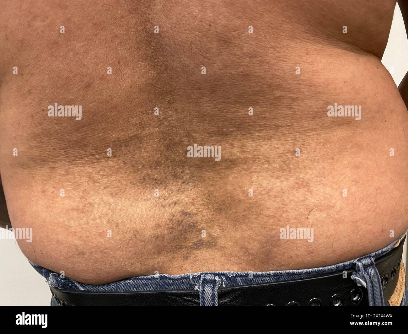 Ashy dermatosis on the back of a 48 year old Hispanic male patient ...